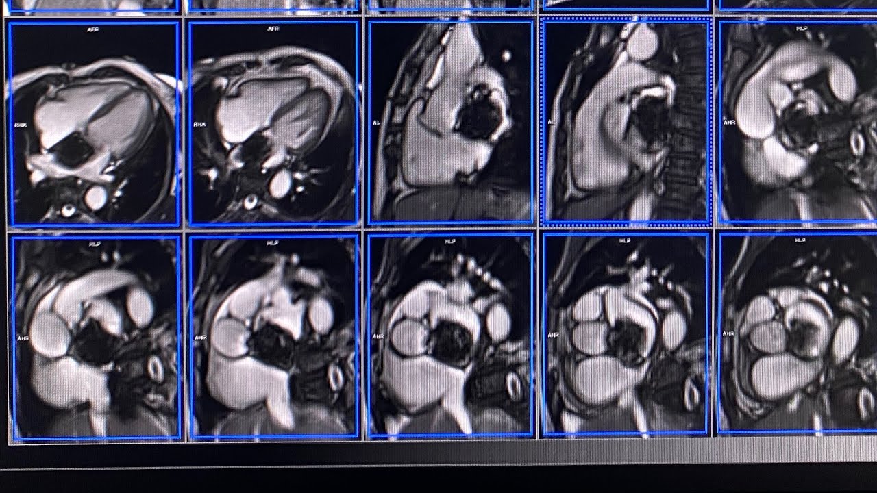Cardiac MRI(Axial & SHAX)Left Atrium Myxoma (Part 1) - YouTube