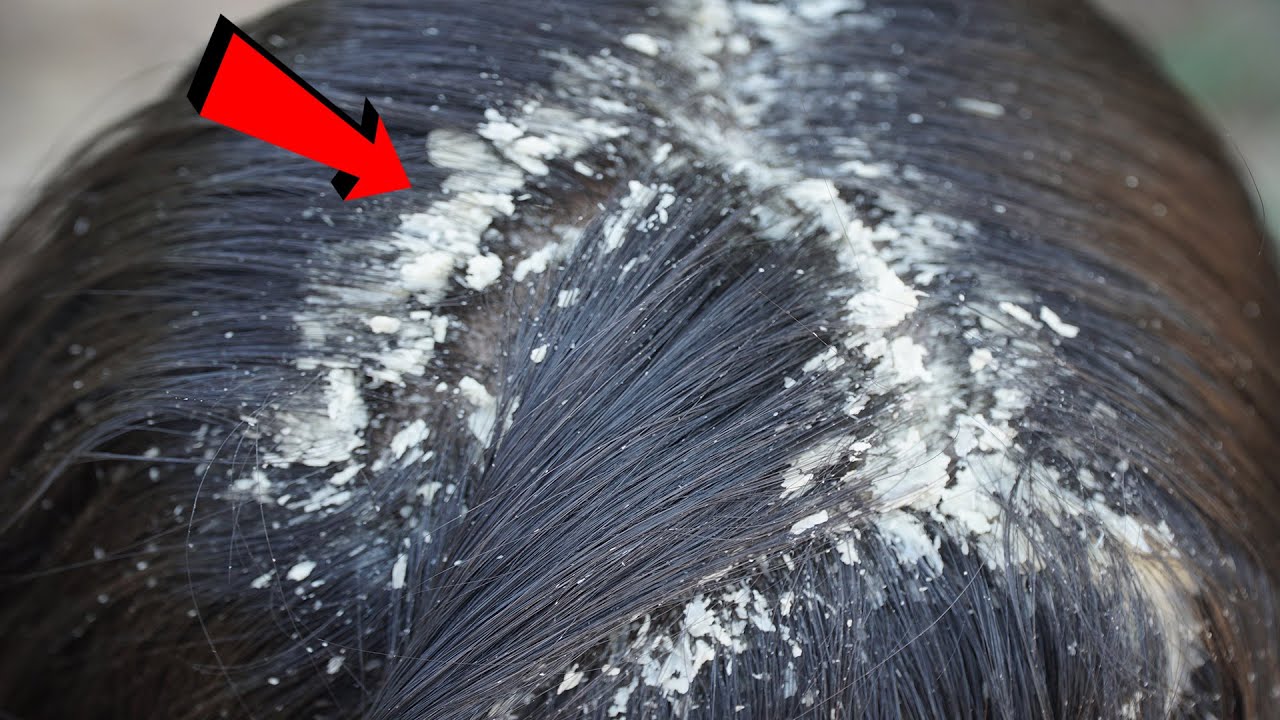 Hair Combing Dandruff / Cialina Channel 1137 - YouTube