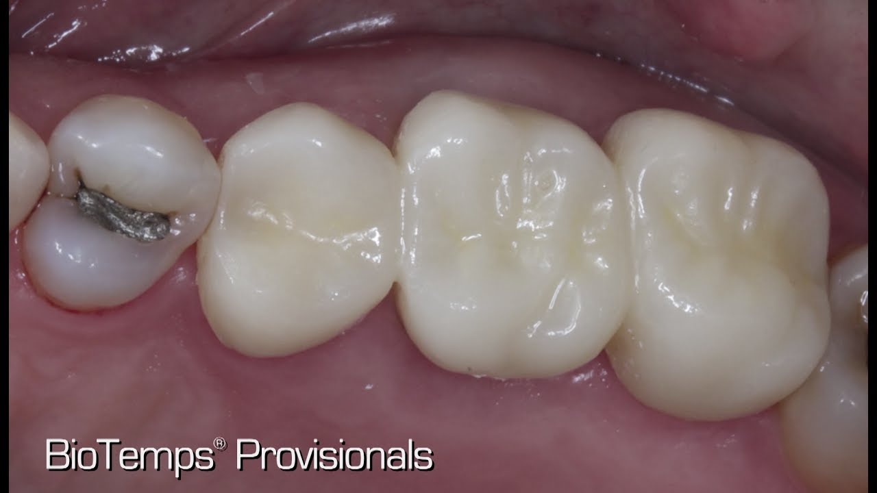 Case of the Week: Restoring the Posterior with a BioTemps® CAD Bridge ...