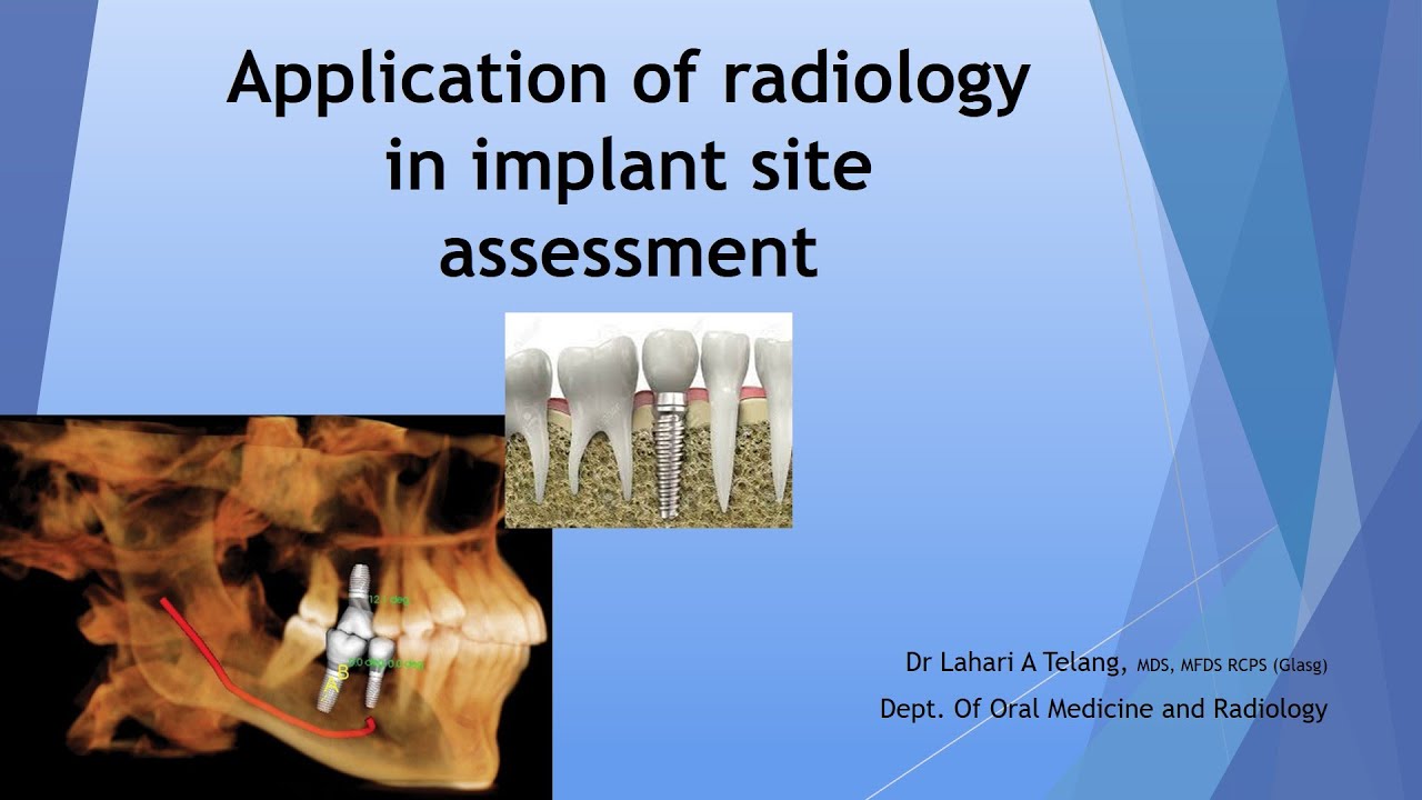 Application of radiology in implant site assessment - YouTube
