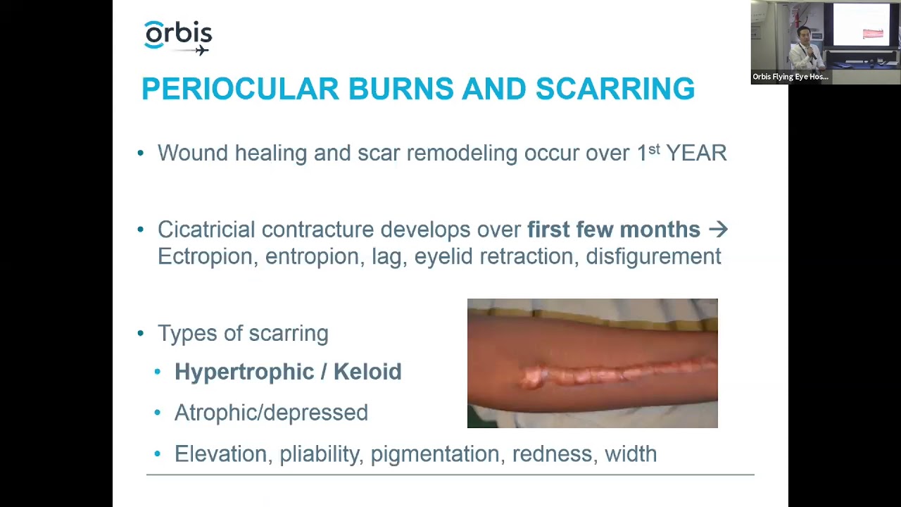 Management of Periocular Trauma and scarring: Dr. Bradford Lee - YouTube