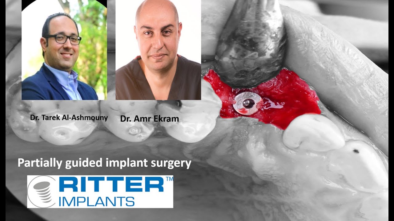Partially guided implant surgery with Ritter implant system - YouTube