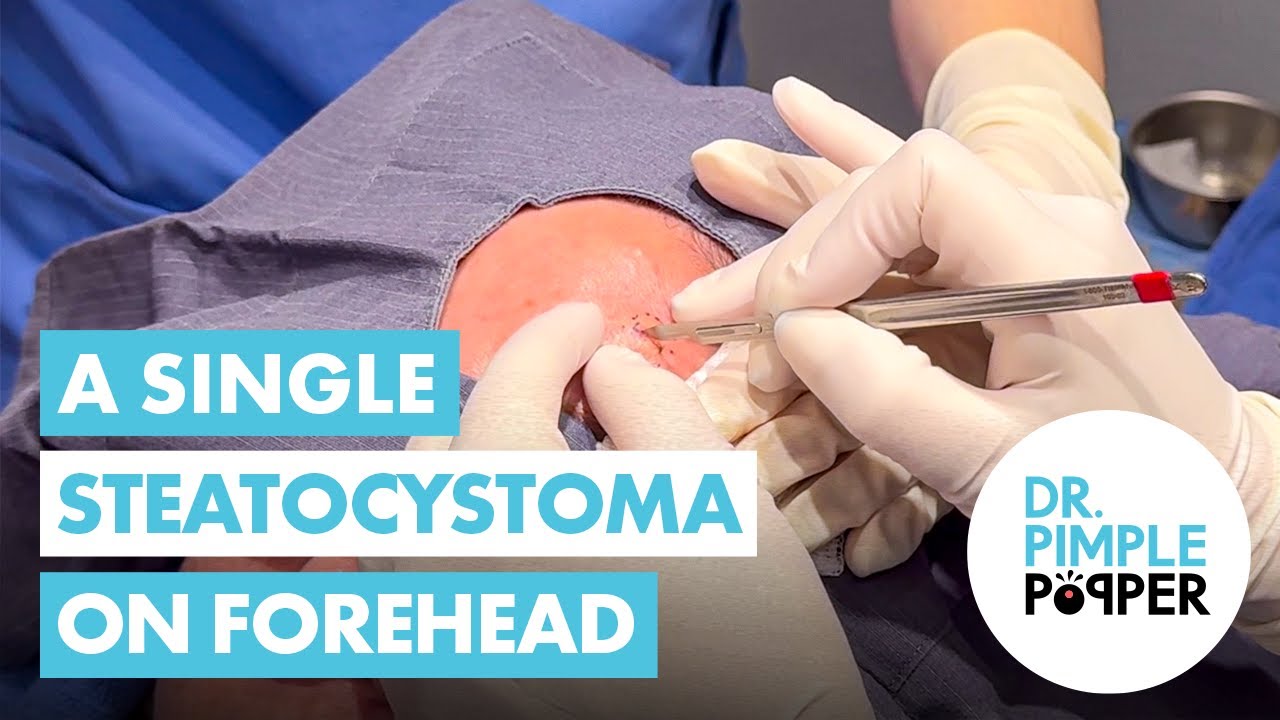 A Single Steatocystoma on Forehead - YouTube