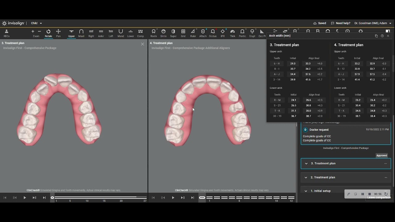 Invisalign First Before and After - YouTube