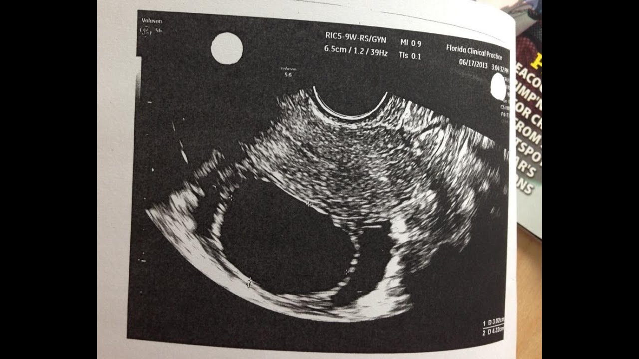 2nd IUI cycle update and plans - YouTube