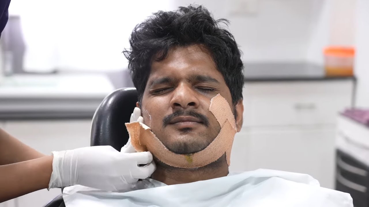 Indian Chin Surgery - Before and After (Genioplasty) - Best ...