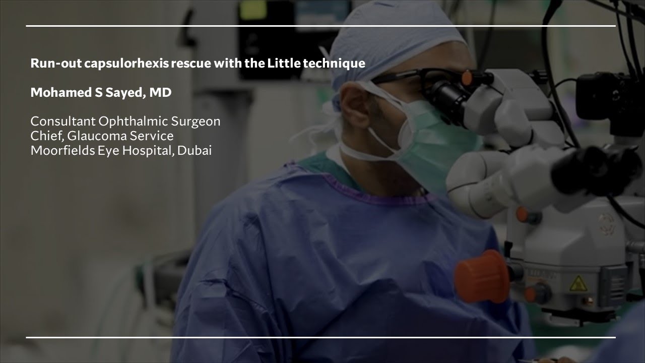 Run out capsulorhexis rescue with the Little technique - YouTube