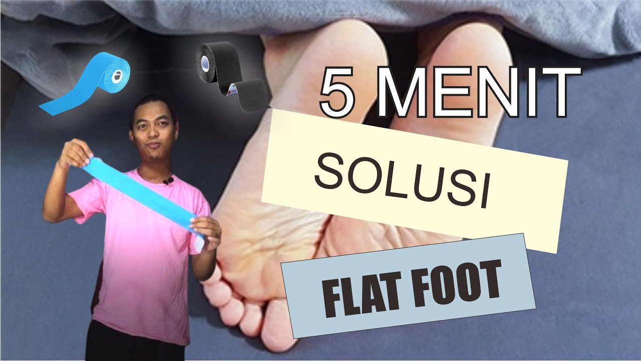 Atasi FLAT FOOT atau KAKI DATAR dalam 5 MENIT - Kinesio Taping Flat ...