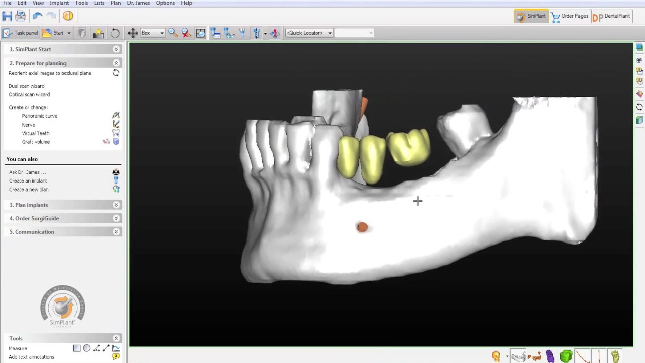 SIMPLANT® Virtual Teeth Planning - YouTube
