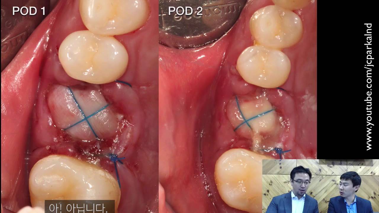 2부-Open Healing Approach Ridge Preservation 해설 영상 - YouTube