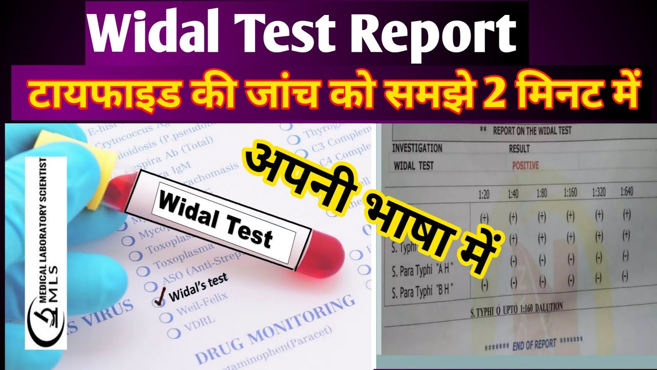 Widal Test Report Reading In Hindi Widal Test Positive Report Widal widal-test-report-reading-in-hindi-widal-test-positive-report-widal
