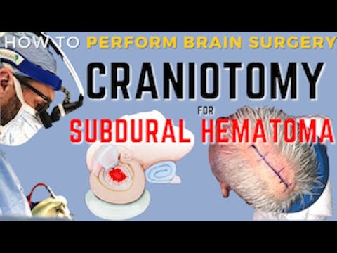 Inside the OR | Brain Surgery - Craniotomy for Subdural Hematoma - YouTube