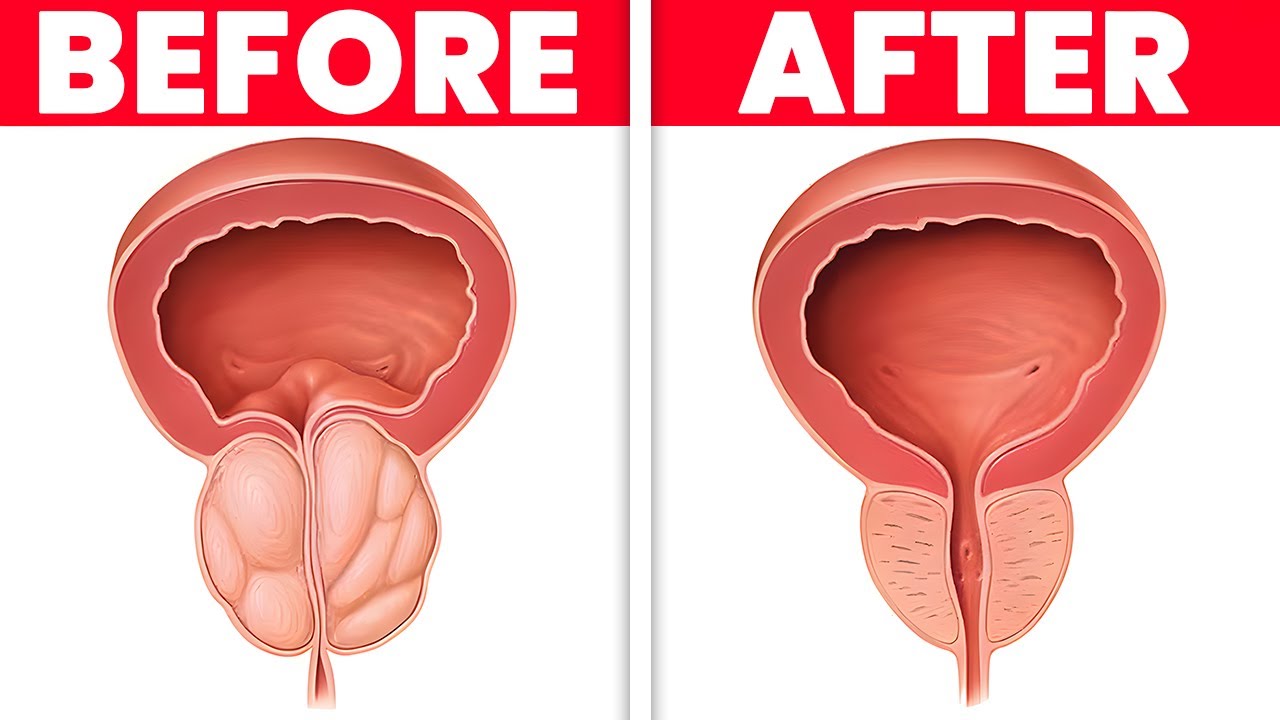 Drink 1 CUP PER DAY To Shrink An Enlarged Prostate YouTube