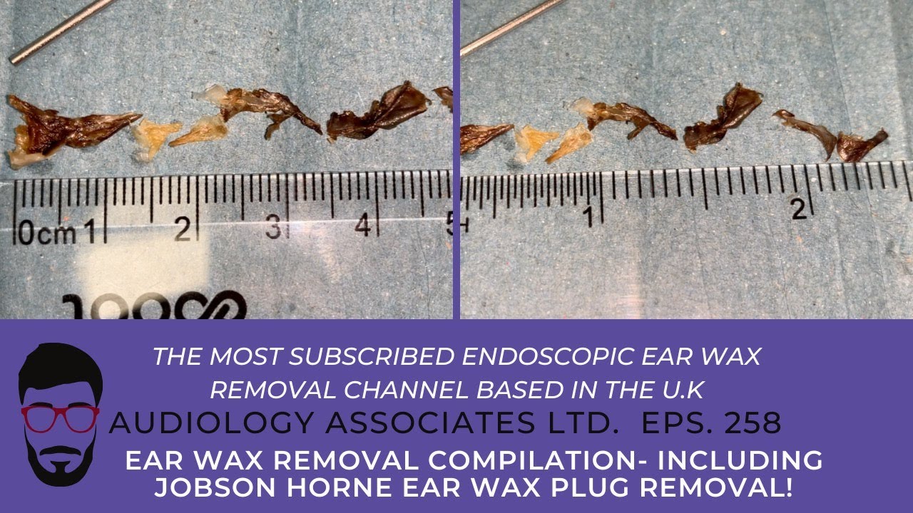 EAR WAX REMOVAL & EAR CANAL PEEL FOLLOWING INFECTION - EP 258 - YouTube