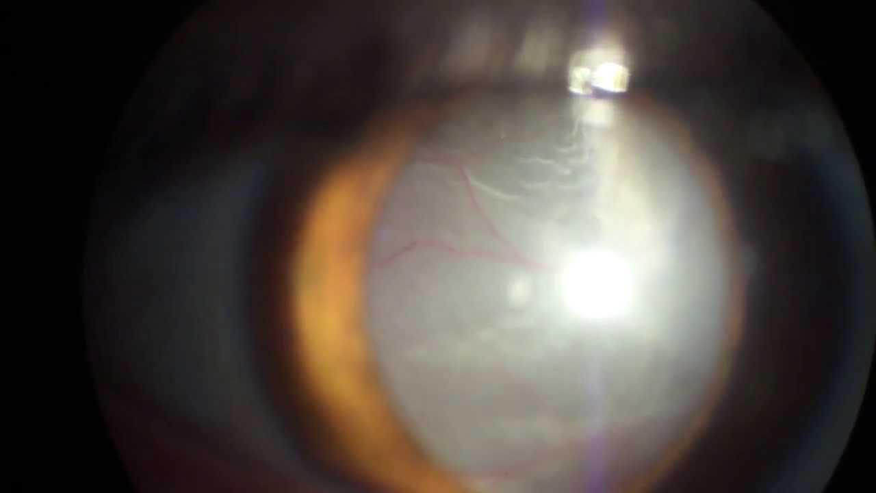 Dr. Andrés Rousselot - Desprendimiento de retina biomicroscopía con ...