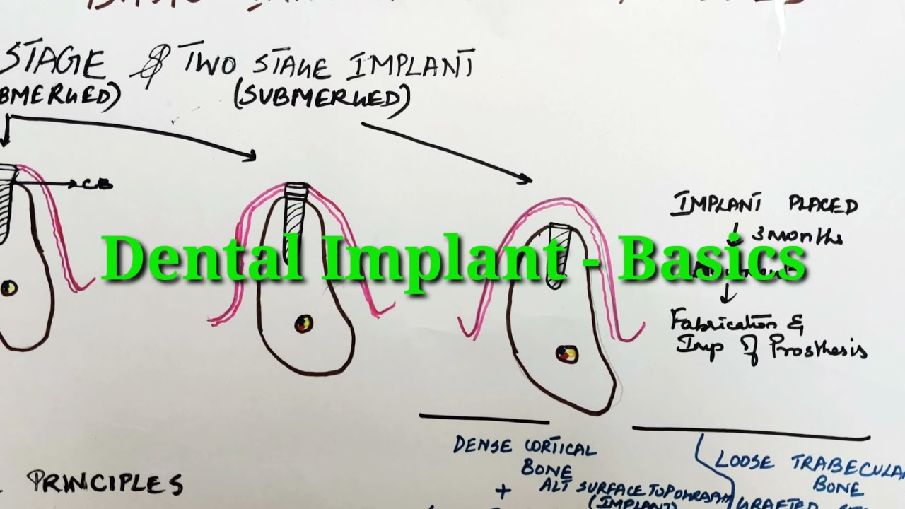 Dental Implant Basics- one stage and two stage implant surgical ...