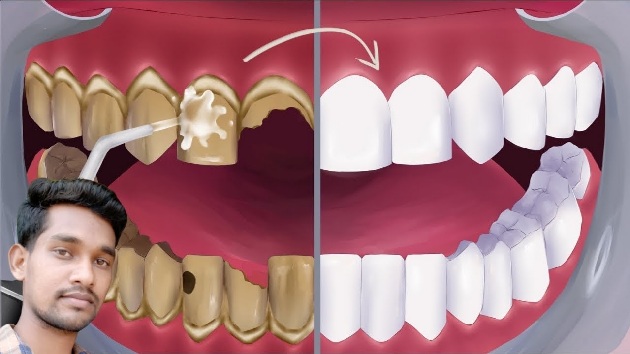 Dental Scaling Teeth Animation Dental Clean😬 #asmr #makeup #traditional ...