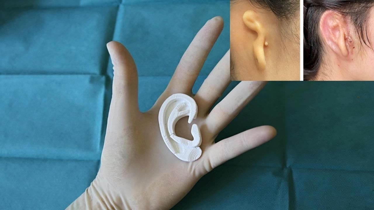 3505 -Woman gets a new 3D printed EAR in world first transplant - YouTube