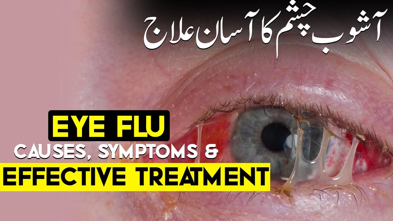 Discover the Shocking Home Remedies that Beat Eye Flu Fast! - YouTube