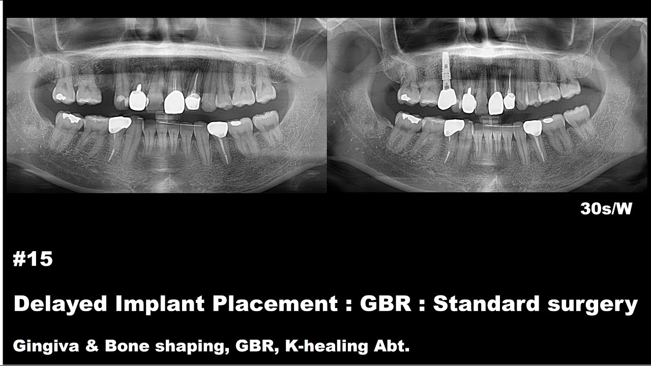 [Dental implant] #15 Delayed Implant Placement : GBR : Standard surgery ...