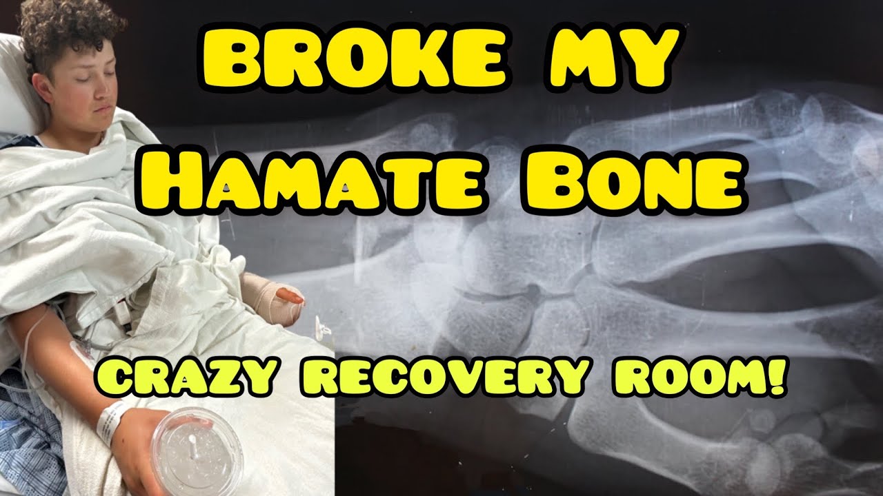 Hamate Surgury- Pre and Post Op. Pretty Funny!! Very Common Baseball ...