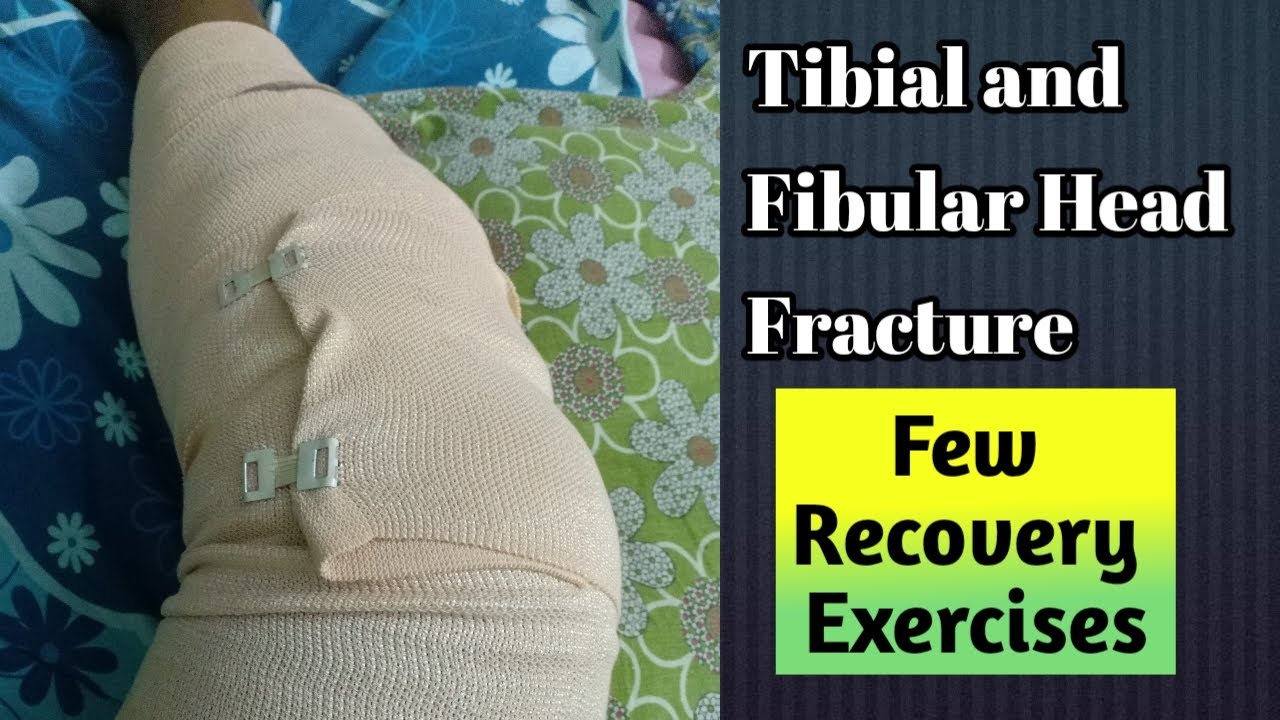 I met with an accident | Tibial and Fibular Head Fracture | Recovery ...
