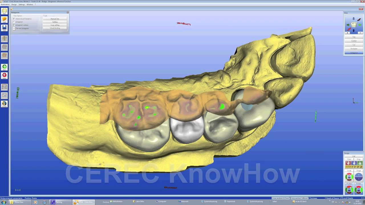 CEREC® Bridge Biogeneric Reference - Bridge - Software - YouTube