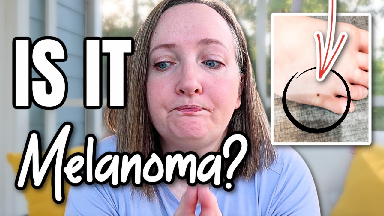 Does My 3 Year Old Have Melanoma Skin Cancer YouTube Does My 3 Year Old Have Melanoma Skin Cancer YouTube