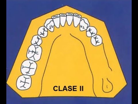 Diseño de PPR clase II - YouTube