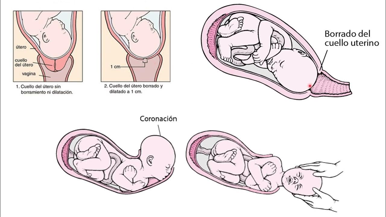 Borramiento Y Dilatación Del Cuello Uterino Youtube