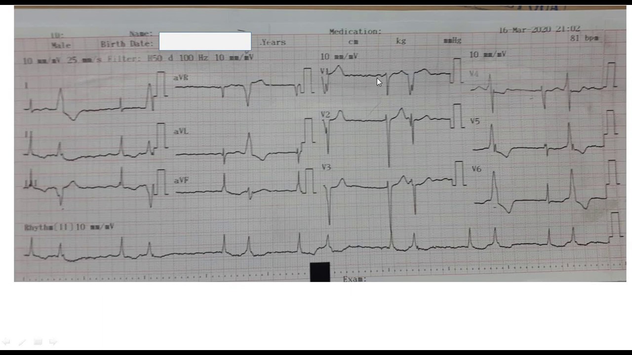 ECG 45 Rung nhĩ và ngoại tâm thu thất - YouTube