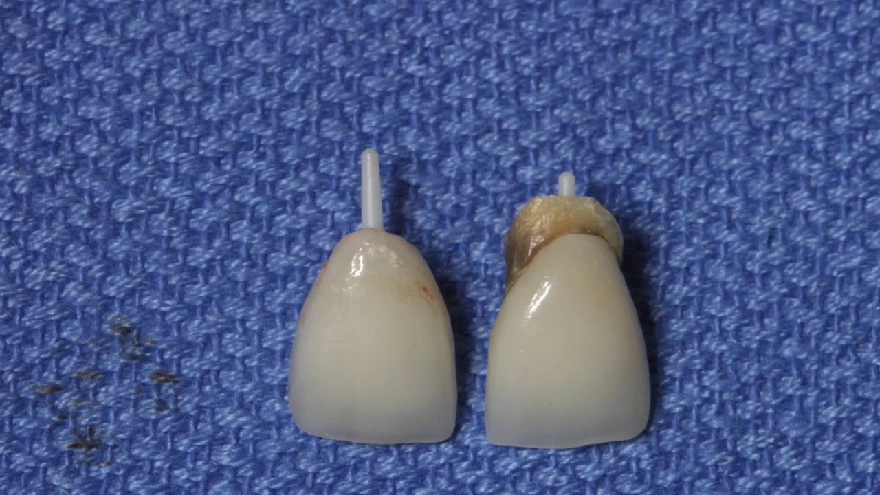 Immaculate replacement of 2 upper front teeth with dental implants ...