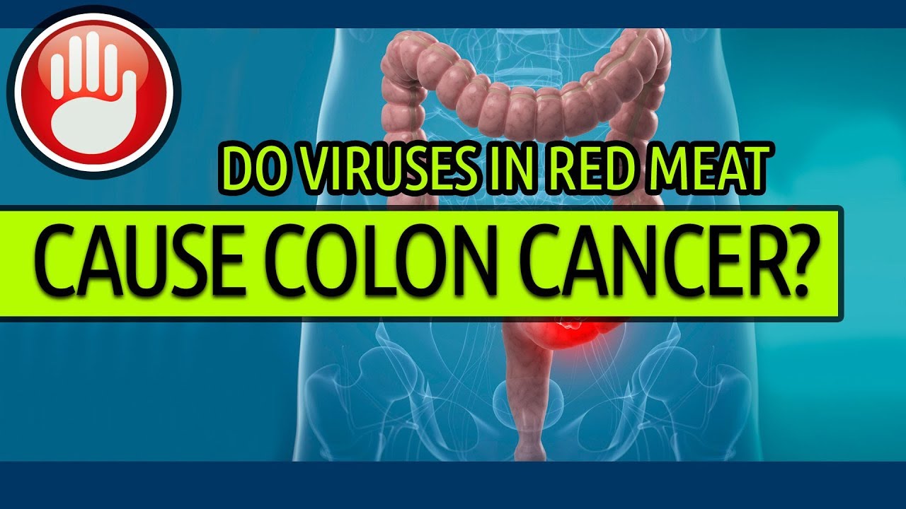 Do Viruses in Red Meat Cause Colon Cancer? - YouTube