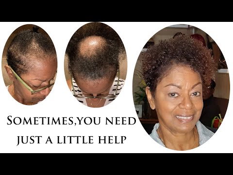 Customer Surprised After She Only Needs A Small Topper For Her Crown Hair Loss