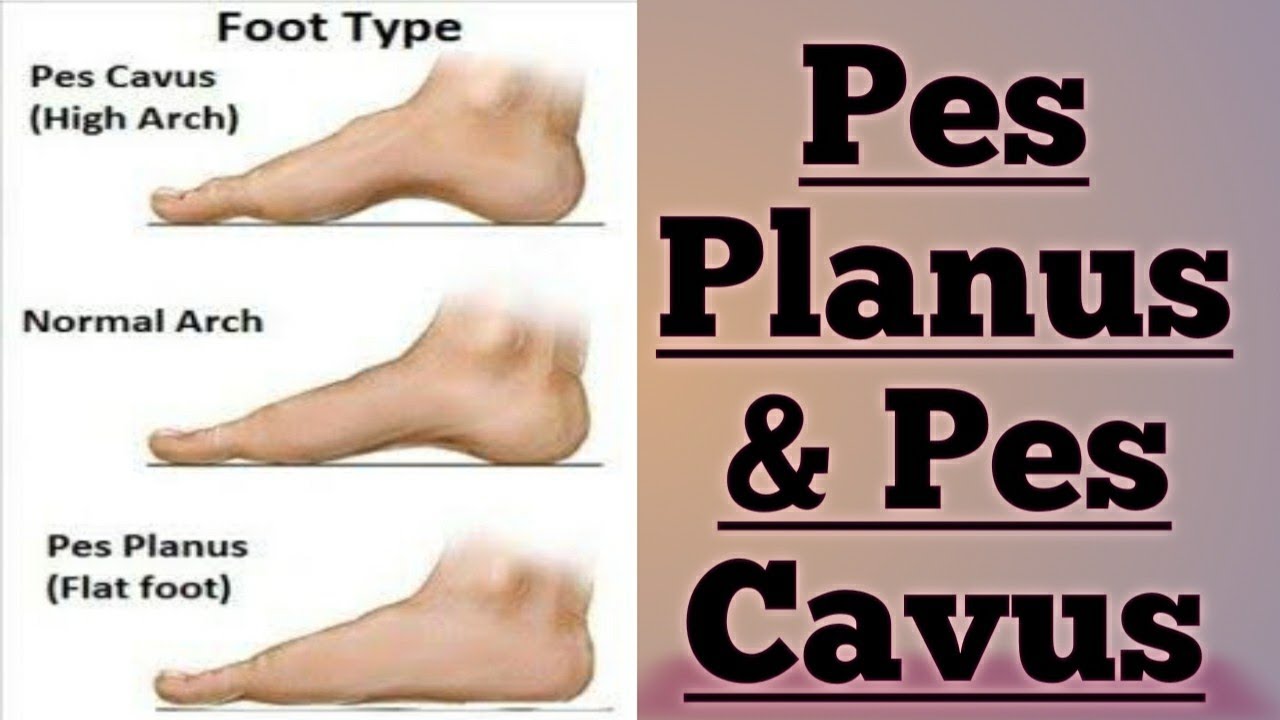 FOOT ABNORMALITIES || PES PLANUS & PES CAVUS || 👍 - YouTube