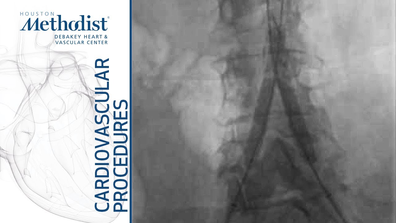 Kissing-Stenting Technique for Aorta-Iliac Lesions (Maham Rahimi, MD ...