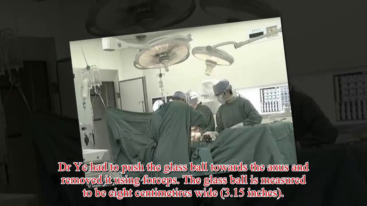 Chinese man, 31, has a 3in wide glass ball stuck in his rectum after ...
