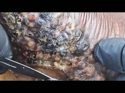 Satisfying videos, jigger cleaning and removal, jiggers digging - YouTube