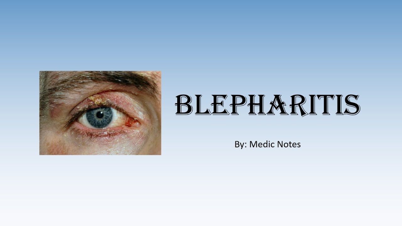 Seborrheic Vs Staph Blepharitis