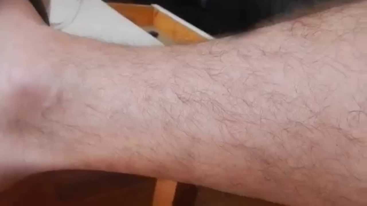 Fasciculations one year later - YouTube