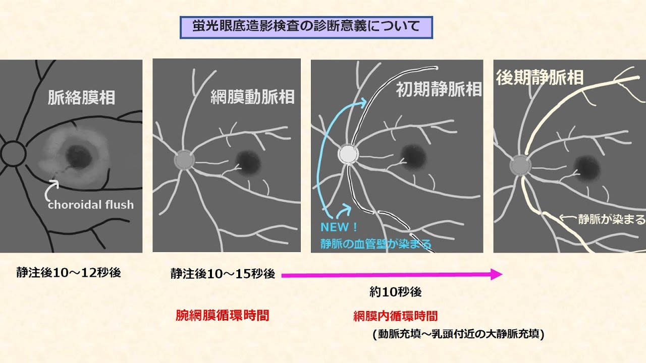 ＃蛍光眼底造影検査 の意義について(FA正常所見、腕網膜・網膜内循環時間、＃逆転現象の仕組み、Window defect、スタルガルド病 ...