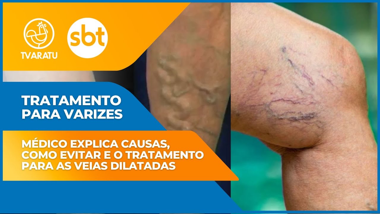 Tratamento para varizes: Médico explica causas, como evitar e o ...