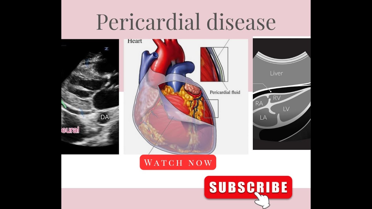 Pericardial disease |causes | diagnosis. - YouTube