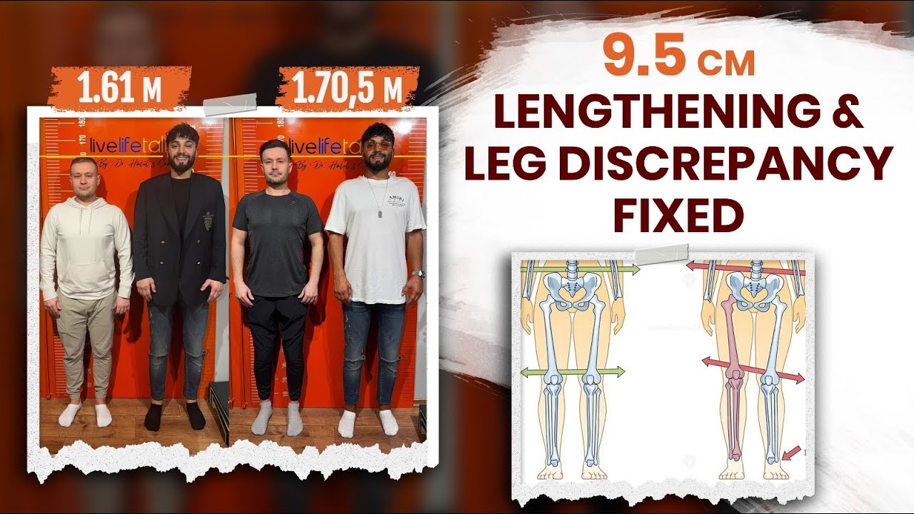 ROMANIAN PATIENT’S JOURNEY: 9.5CM LENGTHENING & LEG DISCREPANCY FIXED ...