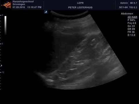 Echografie van de nieren: longitudinaal - YouTube