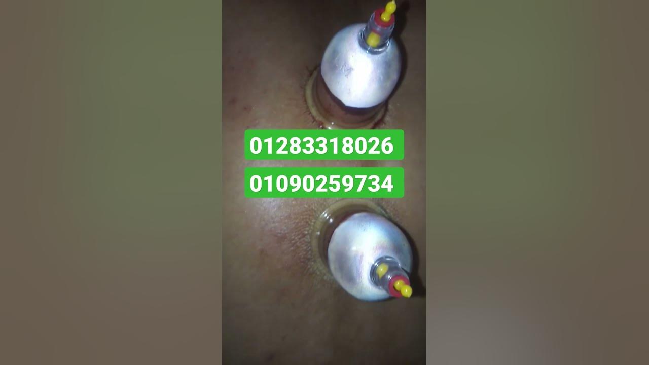 حجامة لألم الرقبة و أسفل الظهر Lower Back حجامةالحجامةالحجامةالنبويةتأهيلحركي