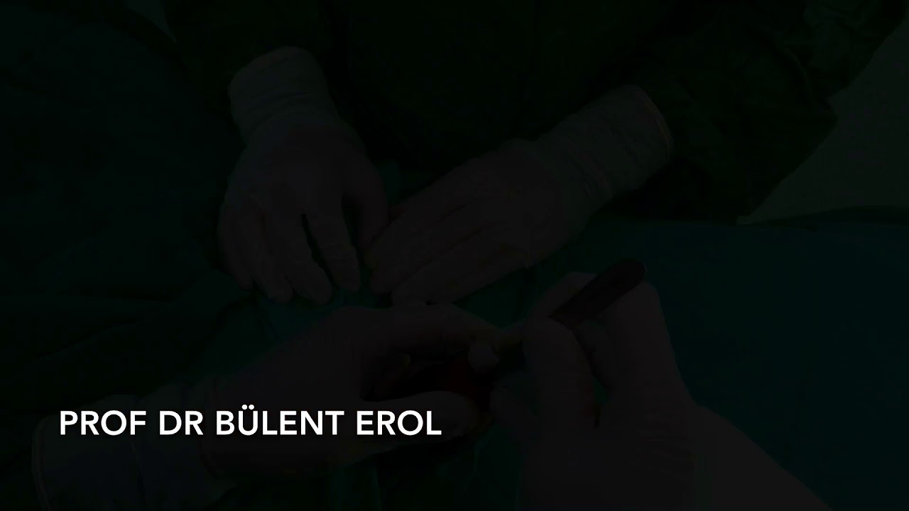 Priapism: T shunt/Tunneling - YouTube