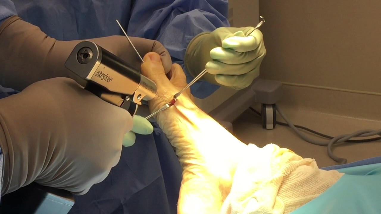 MIS SERI Bunionectomy - YouTube