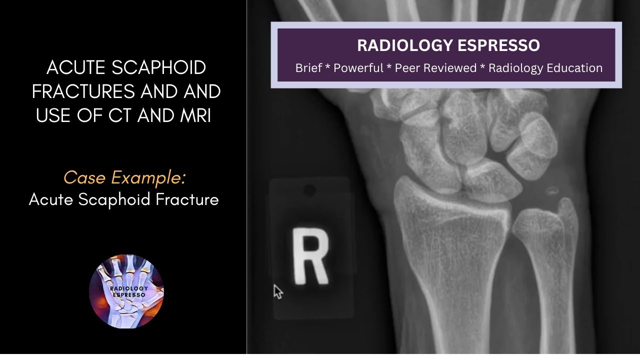 ACUTE SCAPHOID FRACTURES AND FRACTURE COMPLICATIONS: Case Example ...