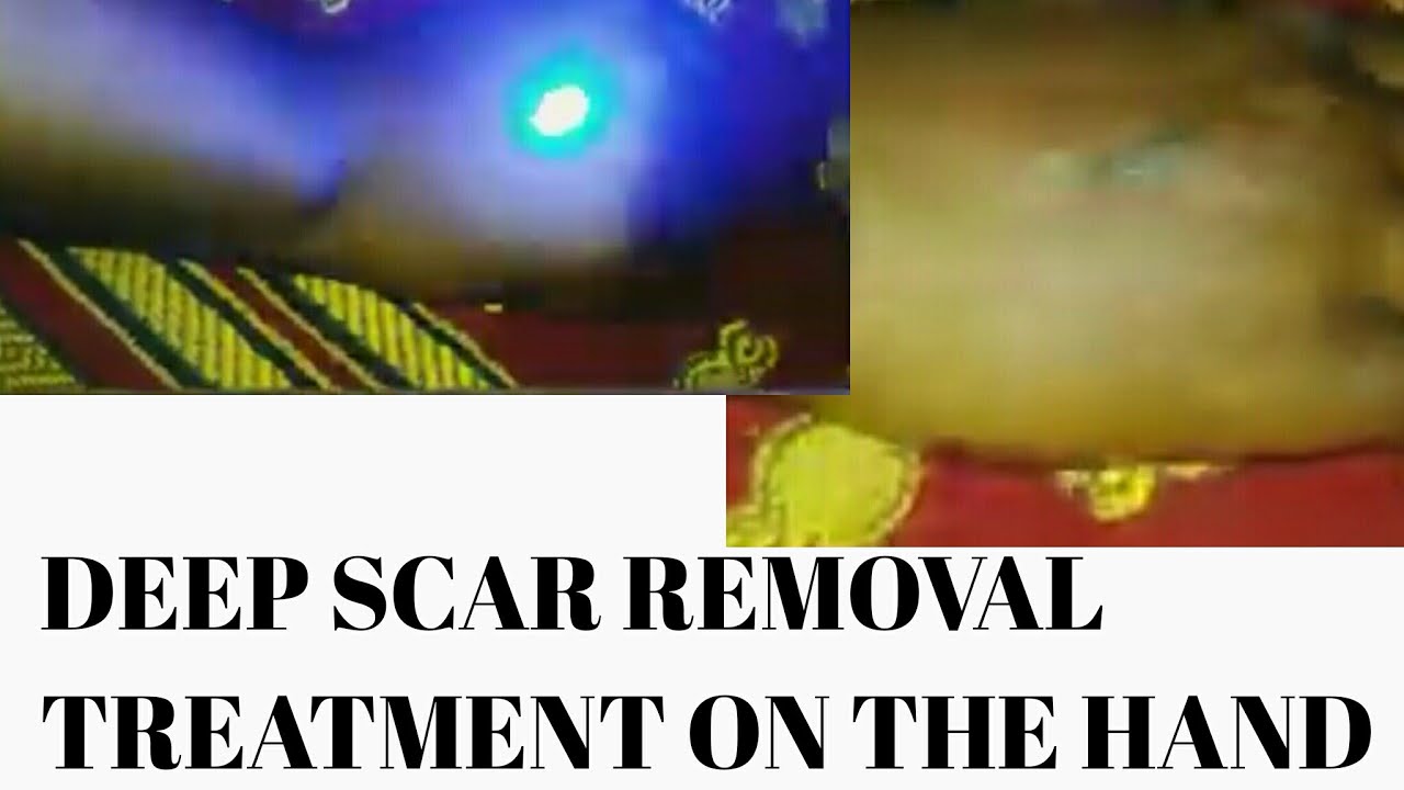 Deep SCAR REMOVAL TREATMENT ON THE HAND UP CLOSE VEIW - YouTube